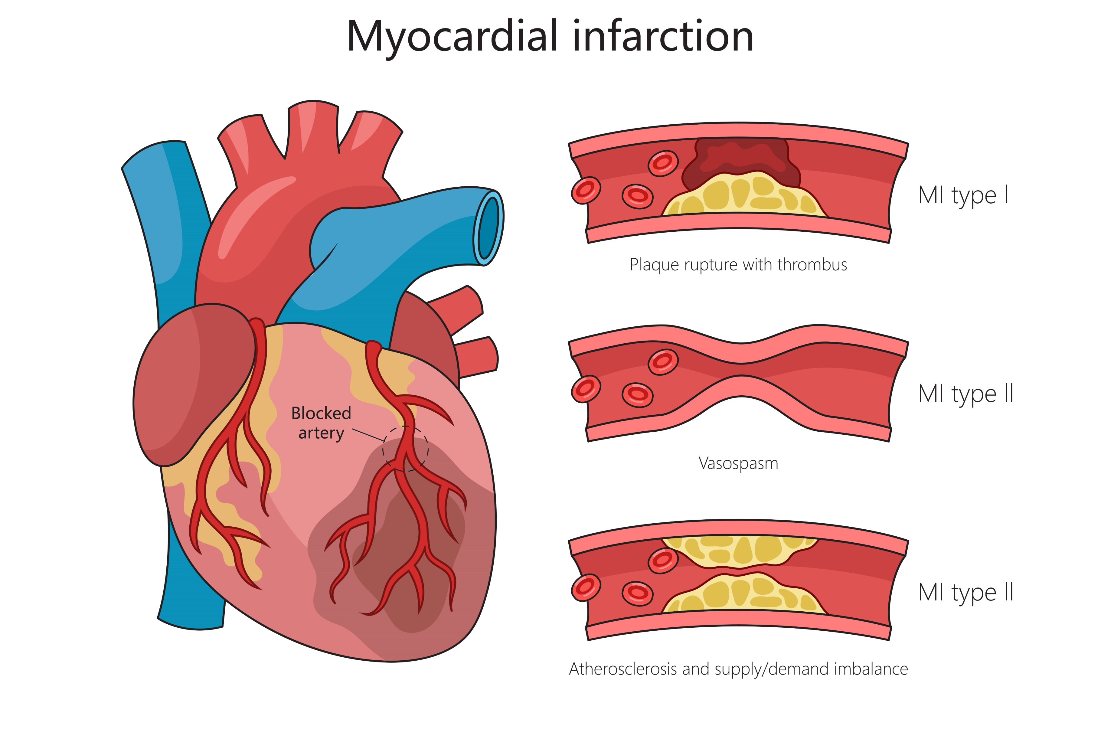 Myocardial Infarction Types diagram, an Object Illustration by AlexArt