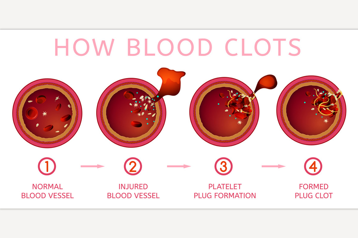 Blood clotting process, a Healthcare Illustration by Anna's Shop ...