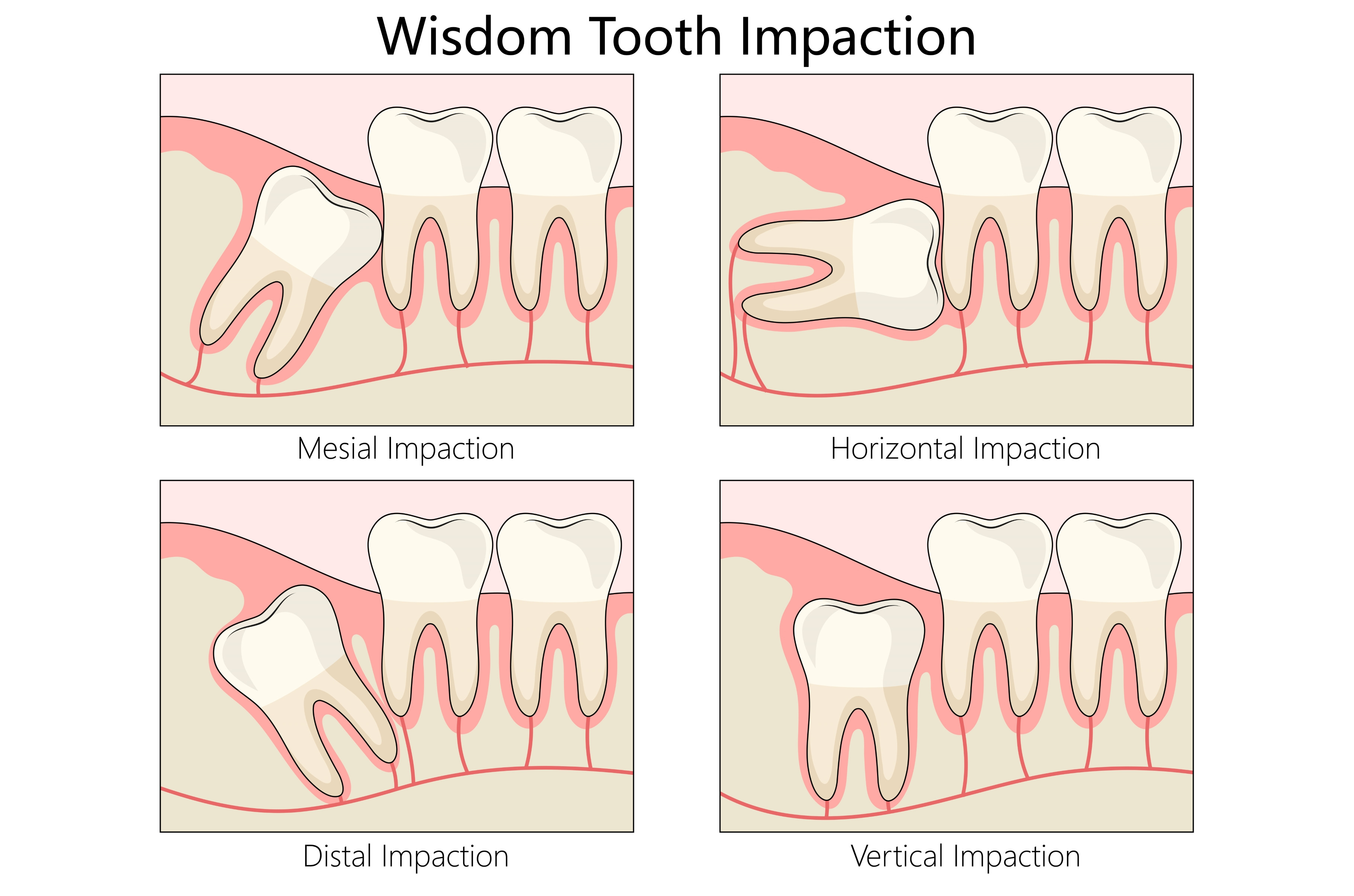 Wisdom Tooth Impaction Types diagram, a Healthcare Illustration by AlexArt