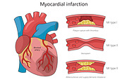 Myocardial Infarction Types diagram | Object Illustrations ~ Creative ...