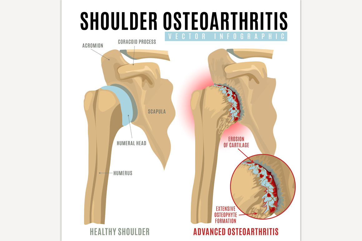 Shoulder osteoarthritis infographic, a Healthcare Illustration by Anna ...