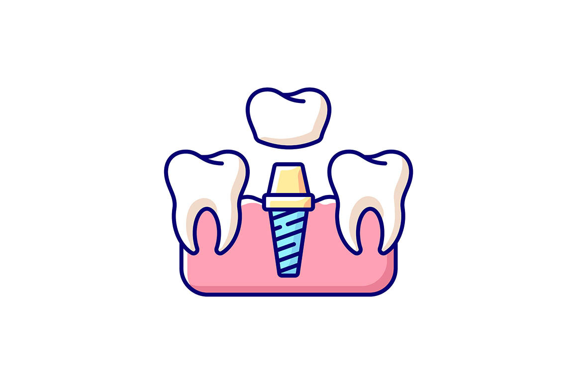 Dental implants procedure RGB color, an Outline Icon by bsd studio