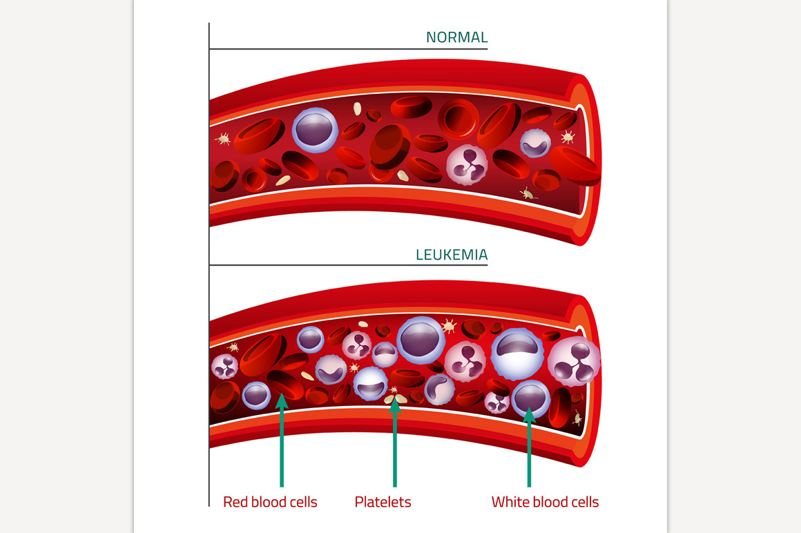 Leukemia Infographic Image, a Healthcare Illustration by Anna's Shop