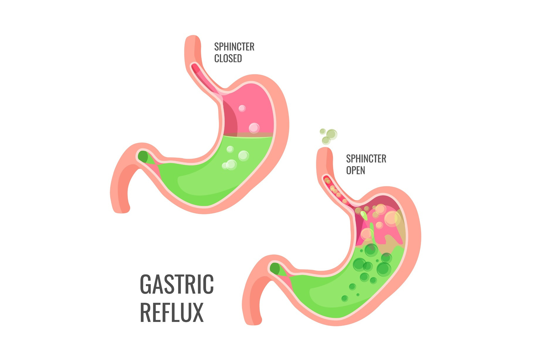 Gastric reflux medical promo poster with human organ, an Object Graphic ...