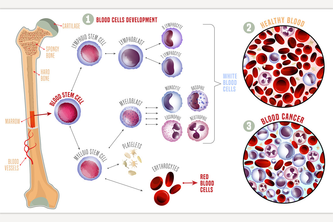 Leukemia medical infographic, a Healthcare Illustration by Anna's Shop