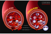 Leukemia medical infographic, a Healthcare Illustration by Anna's Shop