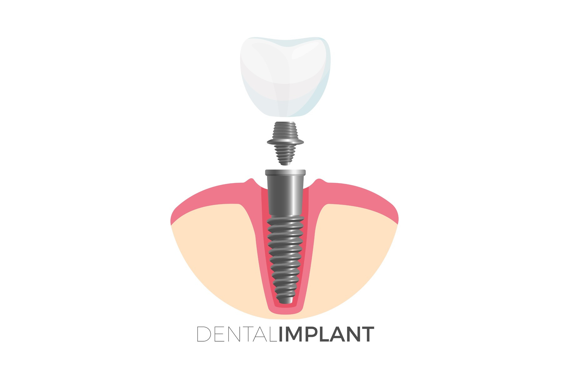 Dental implant tooth and screw on vector illustration, an Object ...
