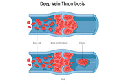 Deep Vein Thrombosis DVT diagram, a Healthcare Illustration by AlexArt