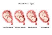 Types of Placenta Previa diagram, a Healthcare Illustration by AlexArt