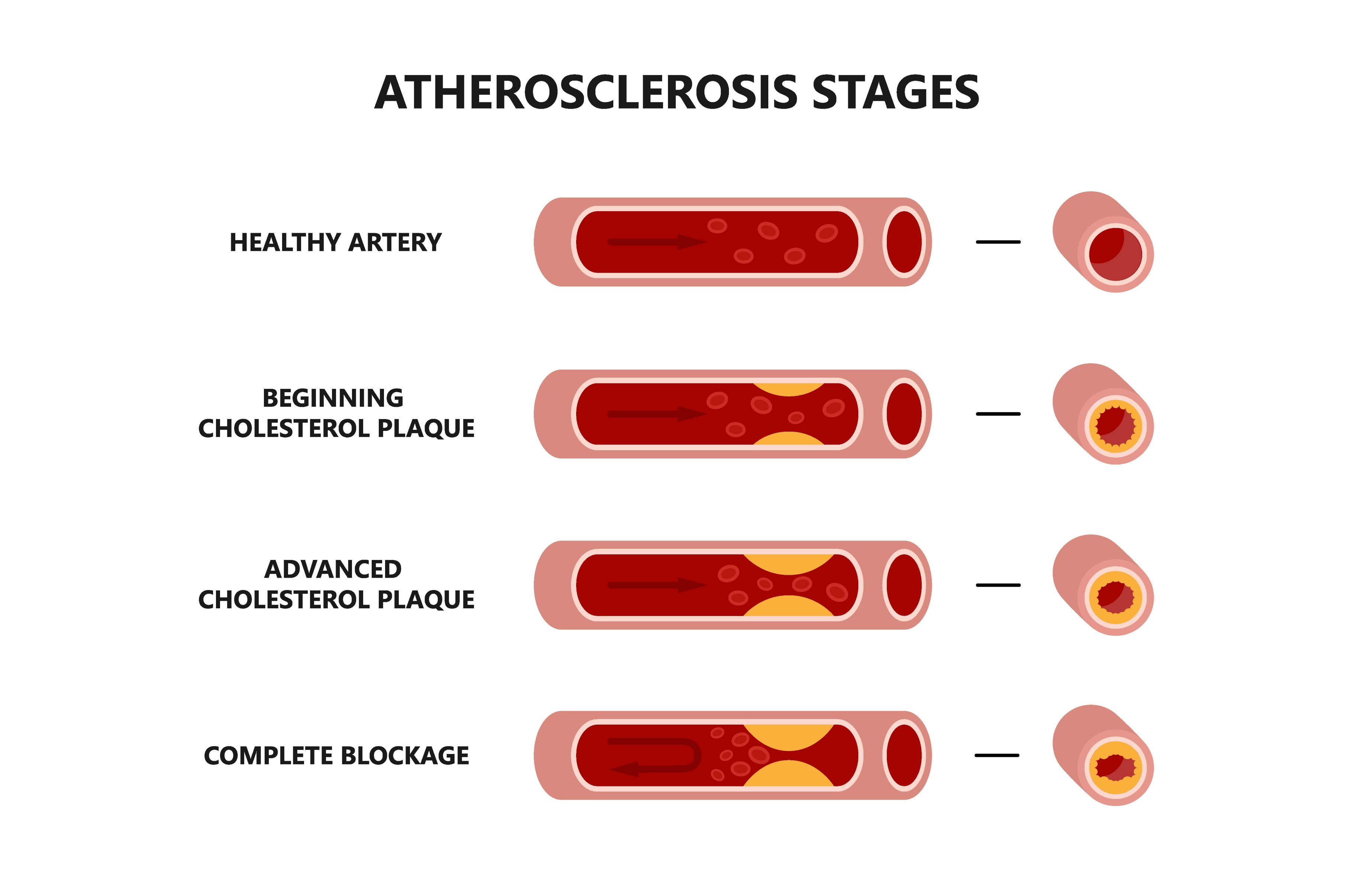 Atherosclerosis formation. Healthy, an Object Graphic by GraphiShop