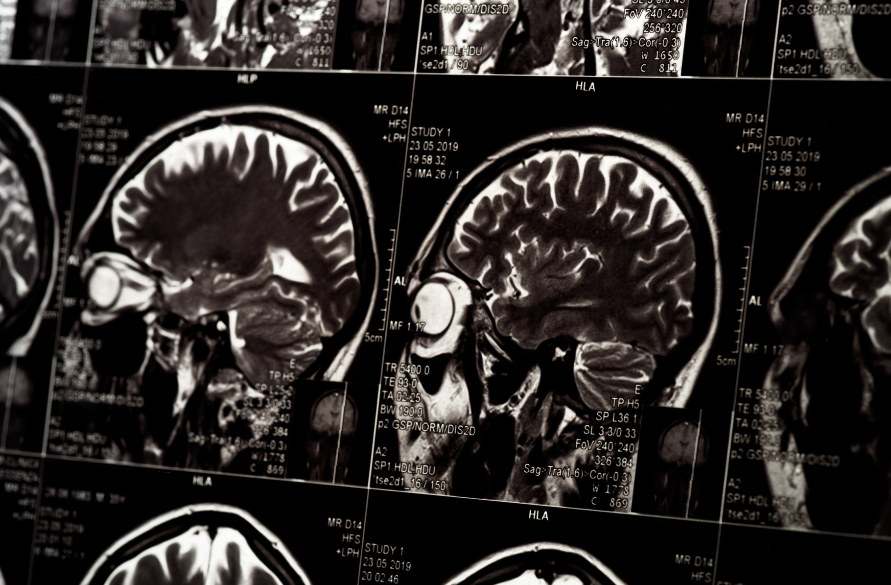 Mri scan of human brain containing brain, scan, and mri, a Health ...