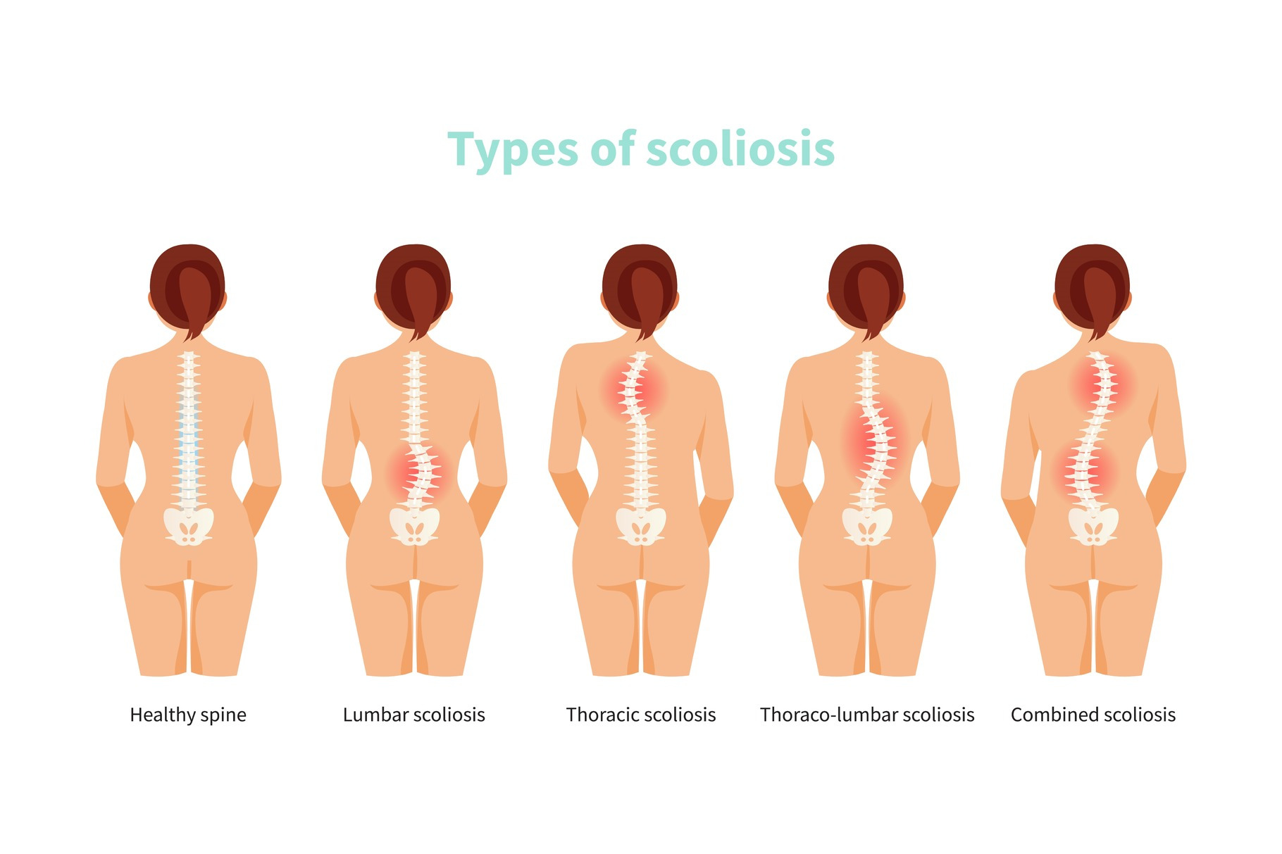 Types of scoliosis vector, a Healthcare Illustration by artbesouro