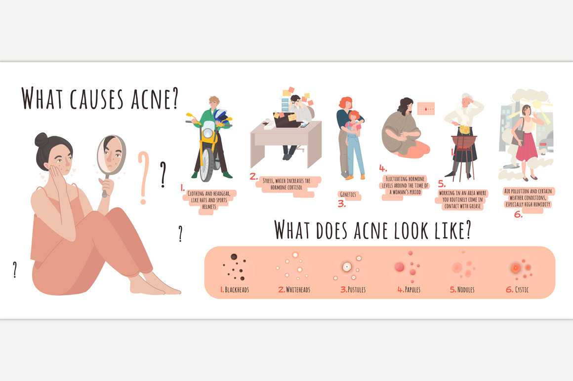 What causes acne. Landscape poster, a Food Illustration by Anna's Shop ...