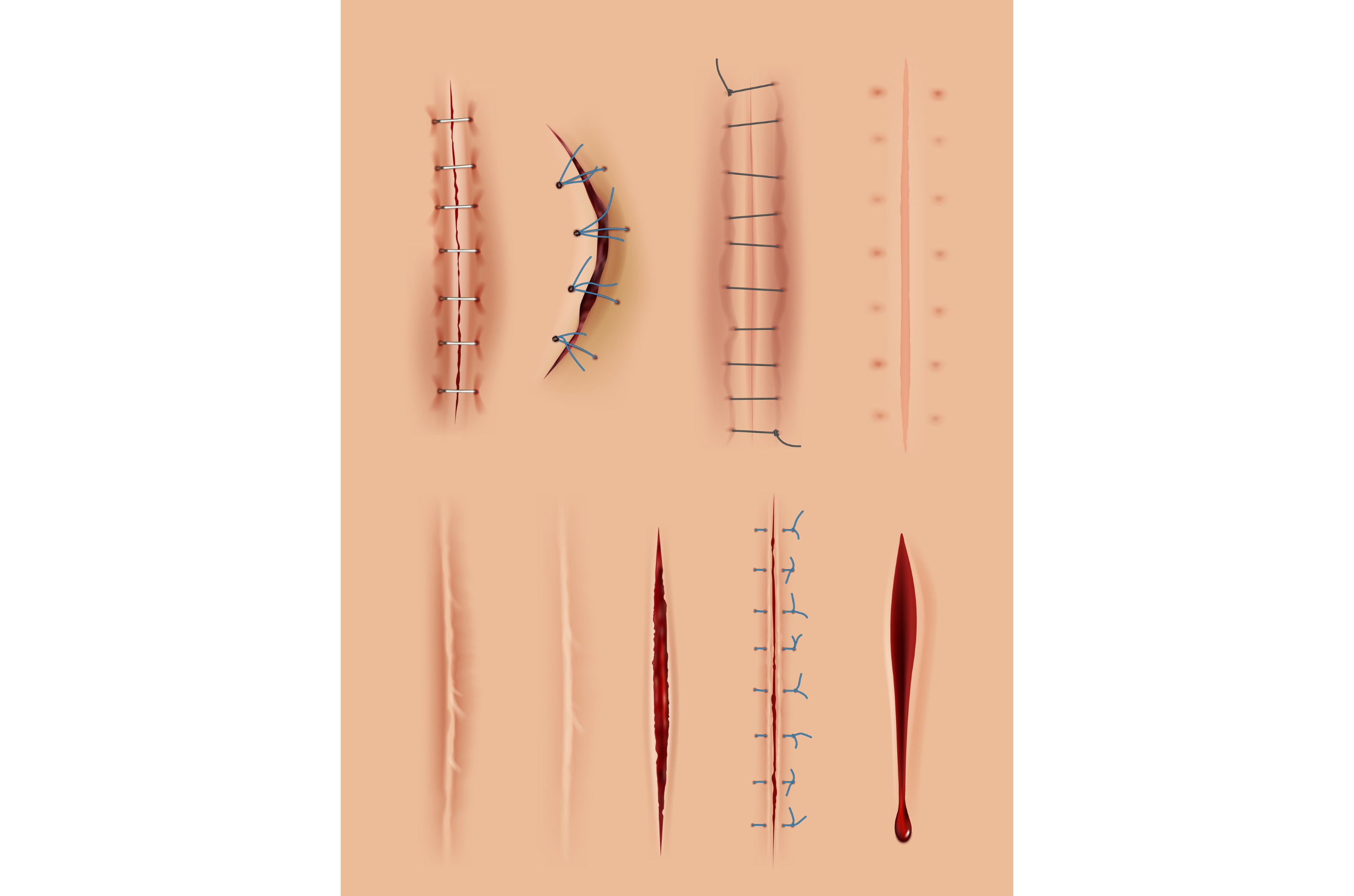 Realistic scars. Medical surgical | Background Graphics ~ Creative Market