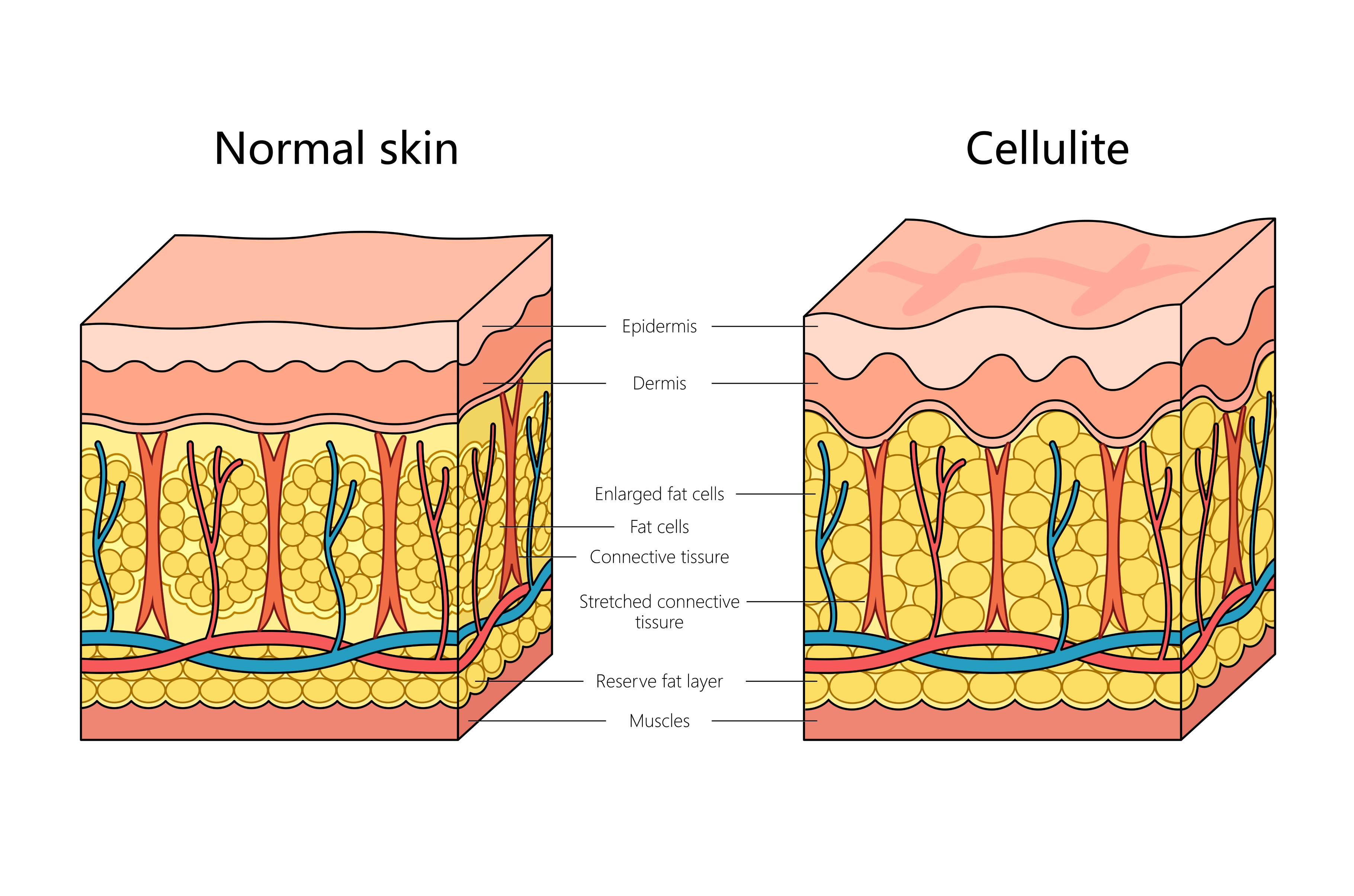 Cellulite skin structure diagram | Object Illustrations ~ Creative Market
