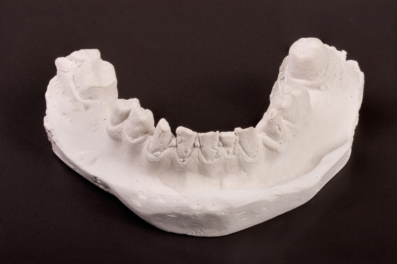 plaster cast of teeth with removable partial denture on a dark ...