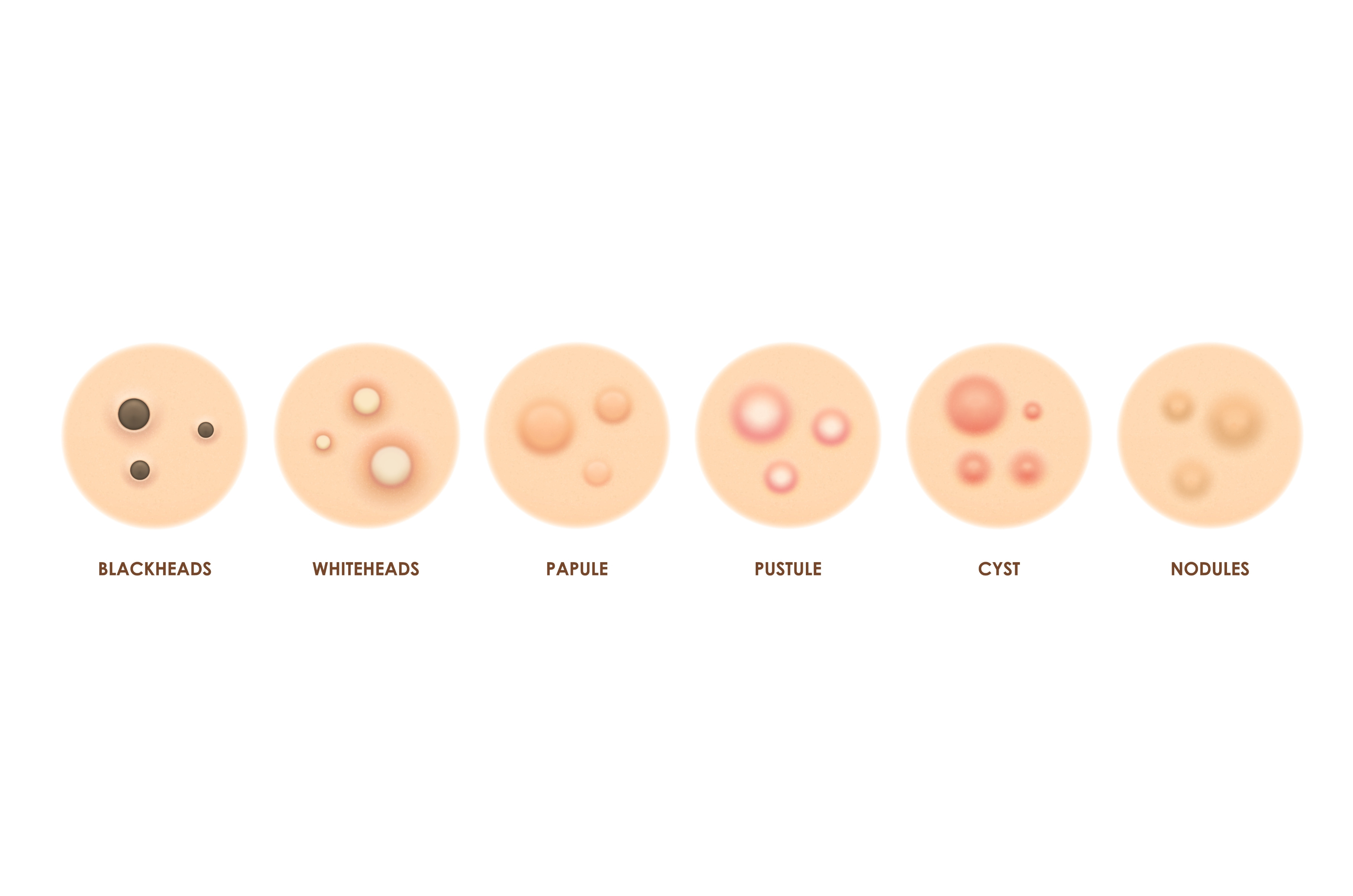Body skin acne types, pimples, a Healthcare Illustration by Vector ...