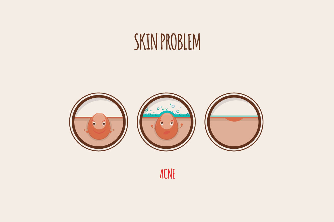 Illustration of acne, a Healthcare Illustration by Semenhorosh